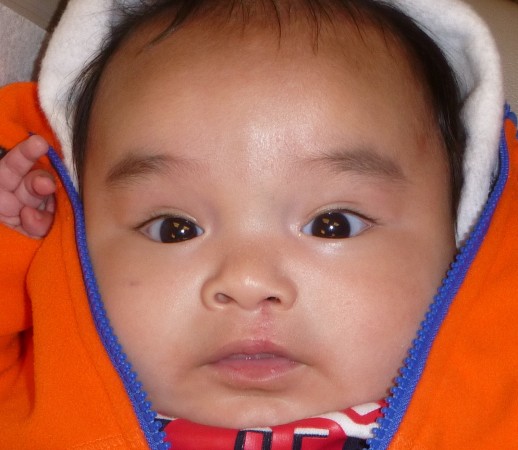 Cleft Lip & Palate for Anchorage, Wasilla, & Palmer, AK – Plastic ...